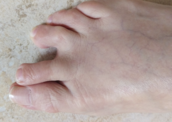 Plantar plate injuries - Be Podiatry