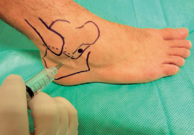 Sinus Tarsi Syndrome Be Podiatry